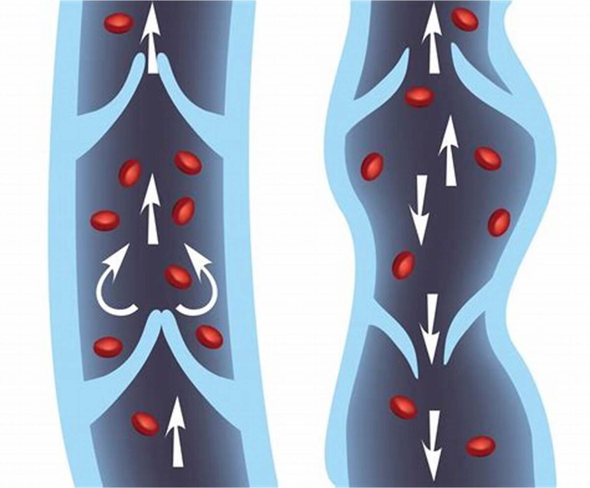 What Is DVT And PE In Medical Terms? - GetMe Treated